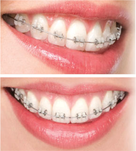 CONVENTIONAL BRACES - Specialized Medical & Dental Centre